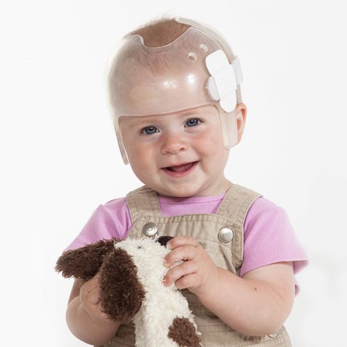 Craniosynostosis | BSSNY Craniofacial Clinic